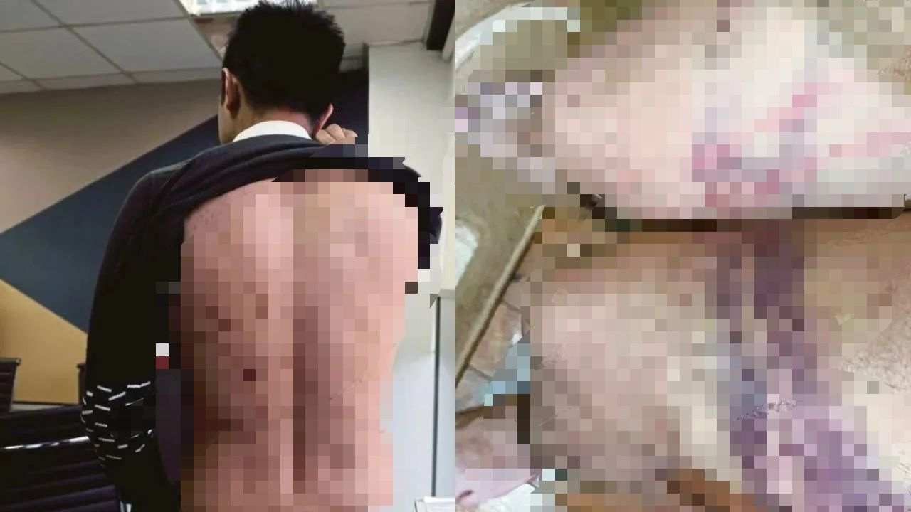 “Saya Dipukul Guna Kabel Treadmill” - Bekas Pekerja Dakwa Didera ...